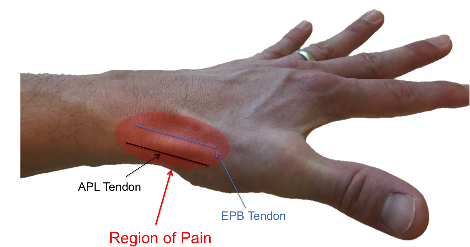 Texting Thumb (De Quervain's Tenosynovitis) - Healthooz