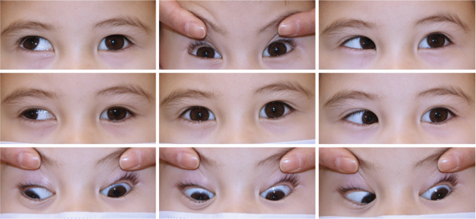 Abducens Nerve Syndrome - Healthooz